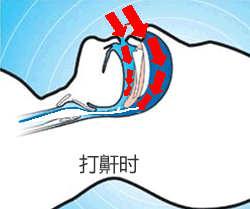 阻塞性睡眠呼吸暂停低通气综合征（OSAHS）_乐玉朋_住院医师_爱问健康